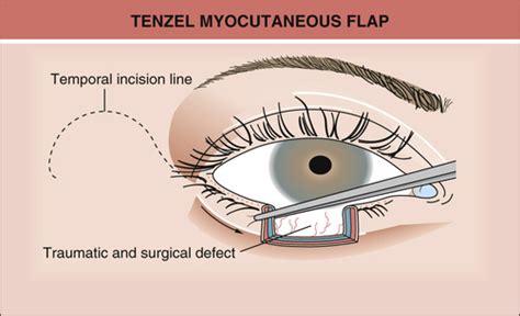 Eyelid Anatomy Reconstruction And Blepharoplasty Plastic Surgery Key