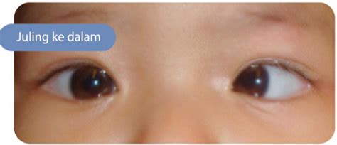Strabismus Mata Juling Matapedia
