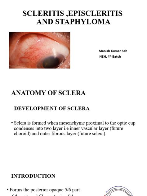 Scleral Disorders Scleritis And Episcleritis Pdf Causes Of Death