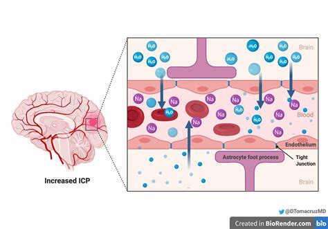 Dealing With Hypertonic Saline In The Neuro Icu Renal Fellow Network