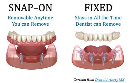 Traditional Vs Snap In Vs Fixed Implant Dentures Which Is Right For