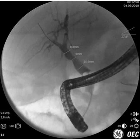 Control ERCP After Months Of The Procedure Adequate Anastomosis Download Scientific Diagram
