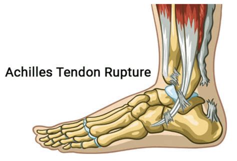 Torn Achilles Tendonitis