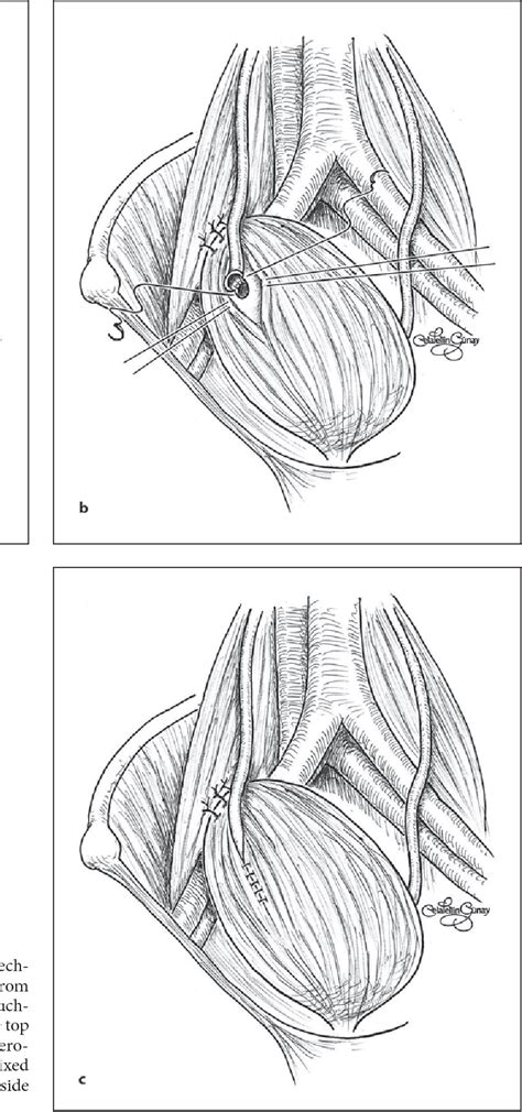 Figure 1 From Modified Psoas Hitch With Lich Gregoir Onlay Technique For The Reconstruction Of