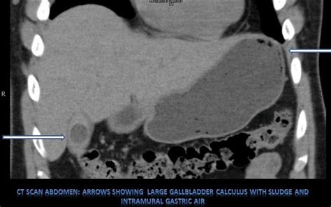 Ct Scan Abdomen Arrows Showing Large Gallbladder Calculas With