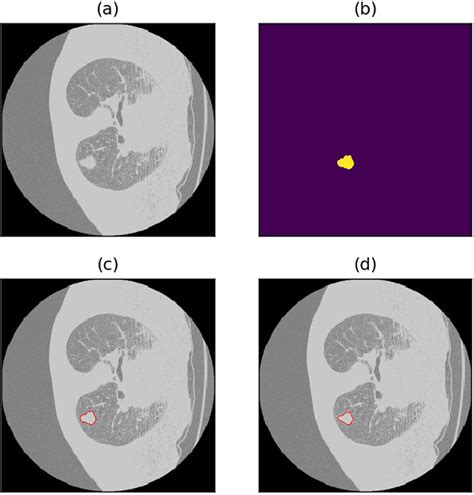 Figure 4 From Lung Nodule Segmentation Via Semi Residual Multi Resolution Neural Networks