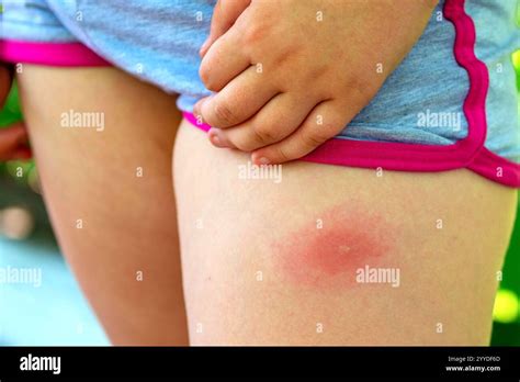The Tick Bite On The Leg Close Up Allergy To Insect Biteswound And