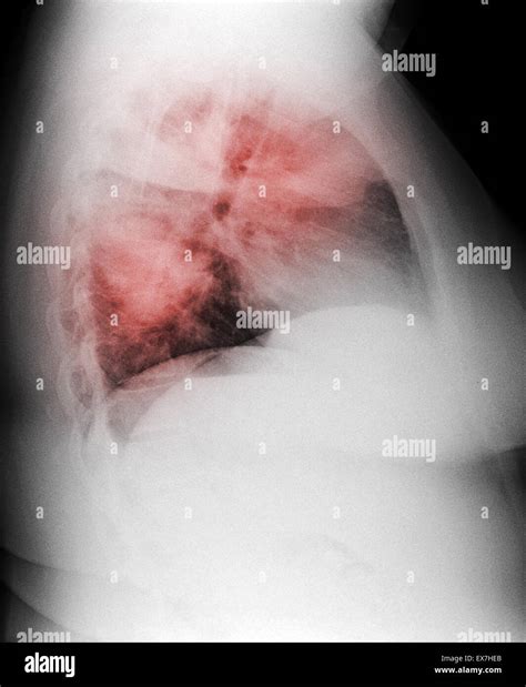 Chest X Ray Showing Diffuse Interstitial Infiltrates Suggestive Of An