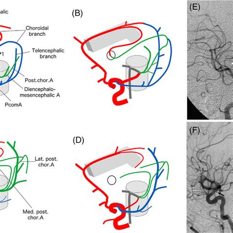 Vascular Patterns Of The Distal Aca Based On The Classification Of