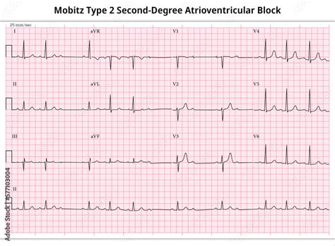 Mobitz Type 2 Second Degree Atrioventricular Block Ecg Paper 12 Lead Electrocardiogram