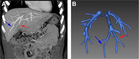 Imaging Of Hepatic Segment 4 Advances In Clinical Radiology