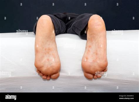 Dyshidrotic Eczema Skin Disease On Sole Of Foot Against White