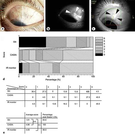 Figure 2 From Development Of An Infrared Monitor Guided Bleb Revision Procedure Semantic Scholar