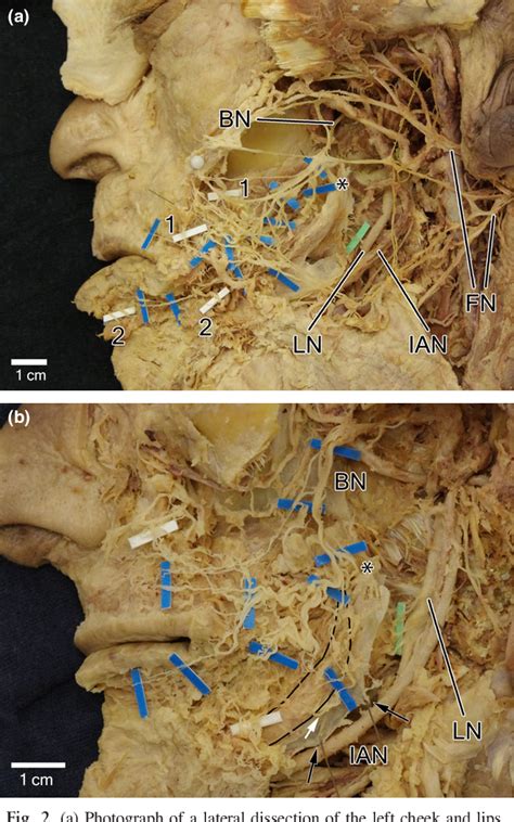 Structure Of Buccal Nerve Semantic Scholar