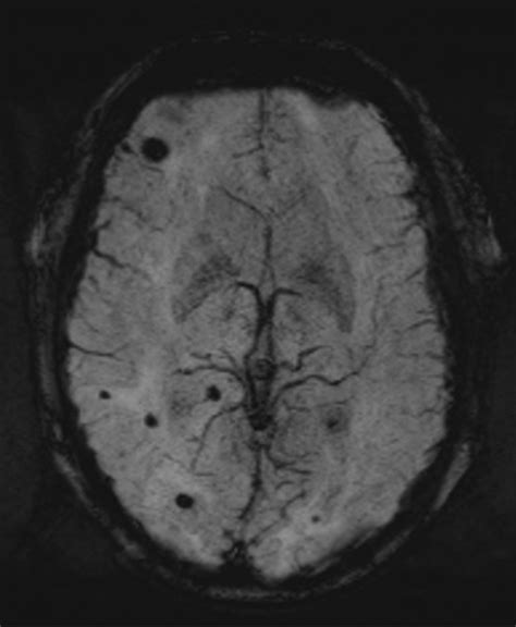 Swi Mri Susceptibility Weighted Imaging Swi