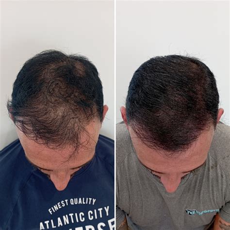 Male Hair Density In Somerset Micro Artistry Hair Clinic