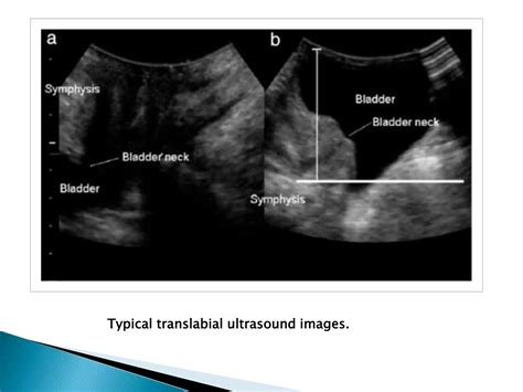 Imaging Of Pelvic Floor Weakness Pptx