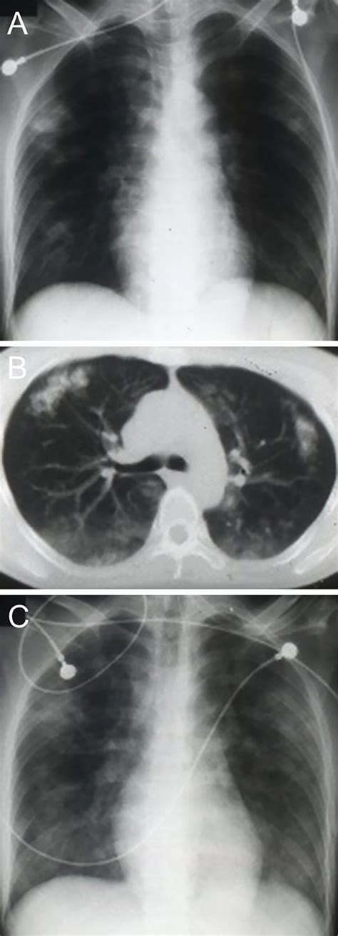 Lethal Visceral Calcinosis In Fulminant Hypercalcemic Crisis