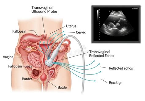 Anatomical Illustration Of Transvaginal Ultrasound Procedure Stock