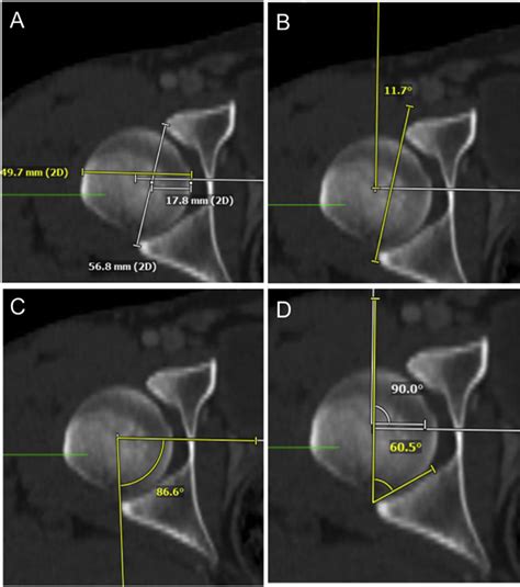 Figure 1 From Acetabular Posterior Wall Morphology A Ct Based Method