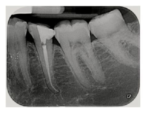 Management Of Internal Replacement Root Resorption With Root