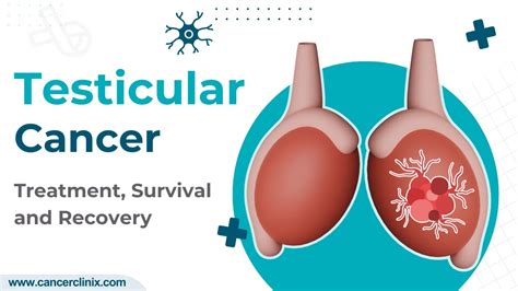 Testicular Cancer Treatment Survival And Recovery