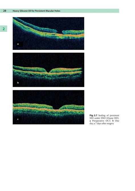 Vitreoretinal Surgery Pdf