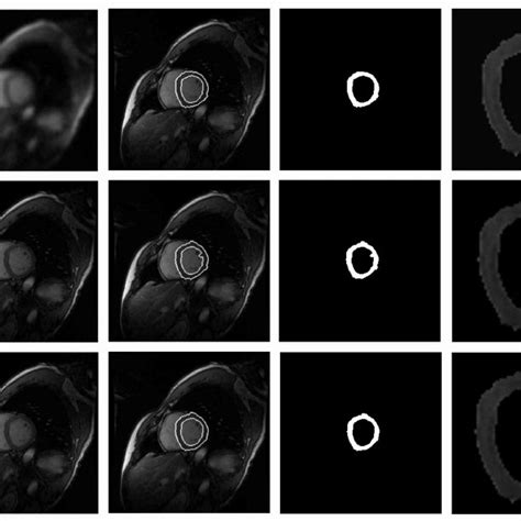 Miocardic Segmentation In The Short Axis Of An Mri Image With The Aad