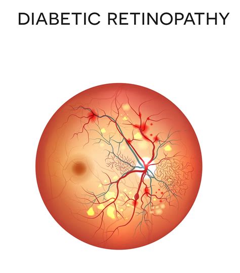 Diabetic Eye Problems Information Treatment Prevention A Guide