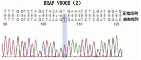 Sequencing Of Braf Gene Exon 15 In Bone Marrow Cells Of Cl Patients Download Scientific Diagram