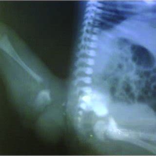 Preoperative Image Demonstrating Parasitic Limb With Buttock And Download Scientific Diagram