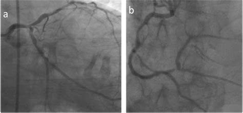 Tryton Dedicated Bifurcation Stent In Treatment Of Unprotected Distal