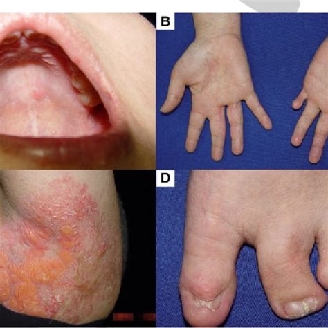 A Schematic View Of The X Dominant Hereditary Pattern Patients