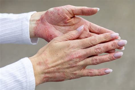 Hands Showing Eczema And Psoriasis Symptoms During A Peaceful Outdoor