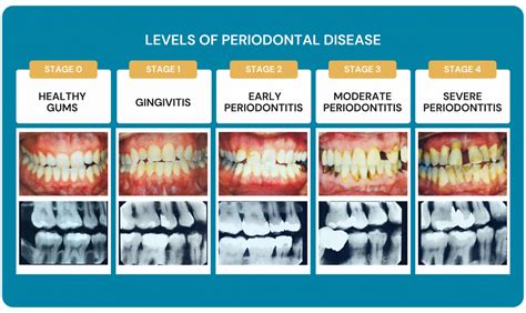 4 Periodontal Disease Stages From Gingivitis To Tooth Loss