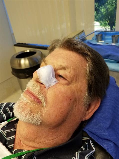 Dlh After Removal Of Basal Cell Carcinoma On Nose Aug 2019 Wayward Sparkles
