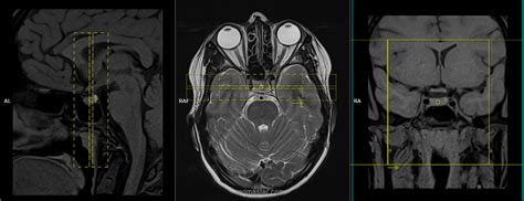 Pituitary Mri Protocols Planing And Indications Pituitary Dynamic