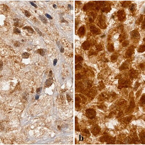 Anti Nrf2 Stains Tumour Cells In Microenvironment Using Ihc A Low Download Scientific