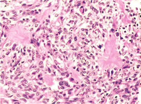 High Power View Of The Tumour Showing Increased Cellularity And Mild Download Scientific