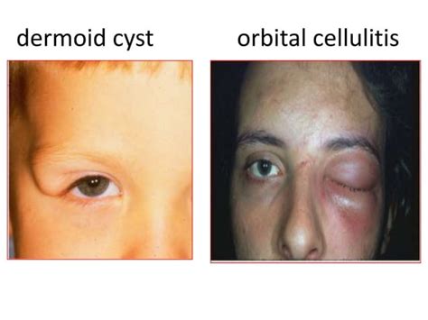 Proptosis In Ophthalmology Pptx