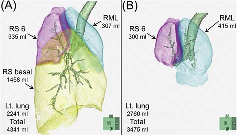 Thoracoscopic Right Basilar Segmentectomy After Right Upper Lobectomy