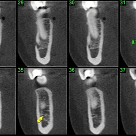 Pdf Relationship Between Mandibular Incisive Canal And Mental Foramen Using Cone Beam Computed