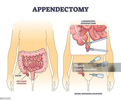 Appendectomy Diagram Shows The Inflamed Appendix Colon And Laparoscopic Surgery Stock