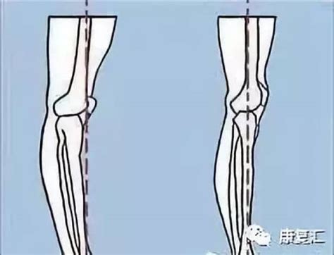 儿童膝过伸 儿童膝过伸矫正器 儿童膝外翻 第10页 大山谷图库