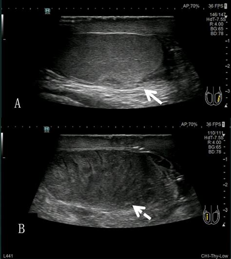 Normal Testis A And Abnormal Testicular B Echotexture Patient 1 Download Scientific