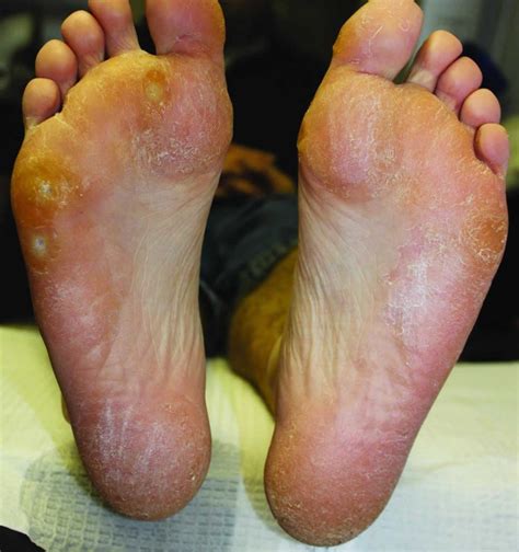 Tinea Pedis Athletes Foot Causes Symptoms Diagnosis And Treatment