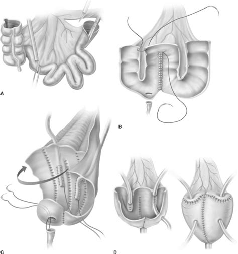 Use Of Bowel In Lower Urinary Tract Reconstruction In Women Abdominal Key