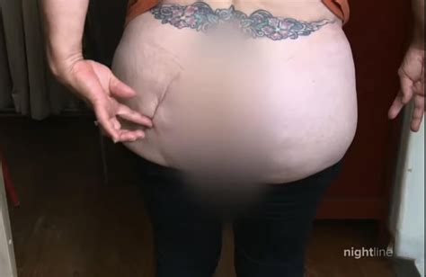 Aftermath Of Illegal Buttock Injections Rbotchedsurgeries