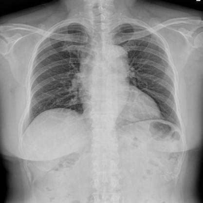 Patient Data 50 100 Object Detection Dataset V1 2022 12 17 2 23am By