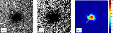 automatic selection of seed point a original octa image b the